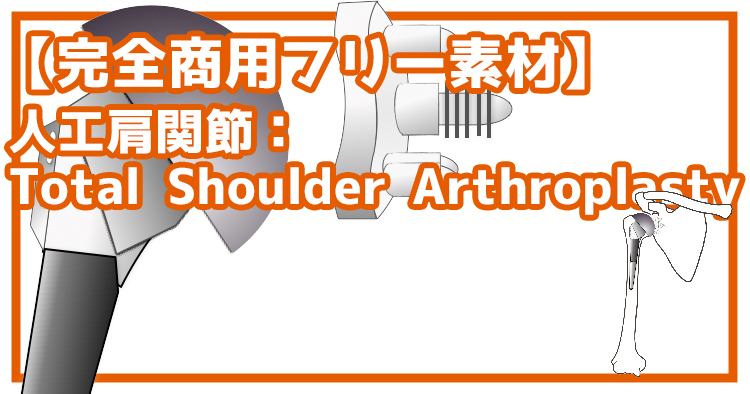 【完全商用フリー素材】自由に動かせる人工肩関節（thatota 理学療法士・作業療法士・言語聴覚士の求人、セミナー情報なら【post】