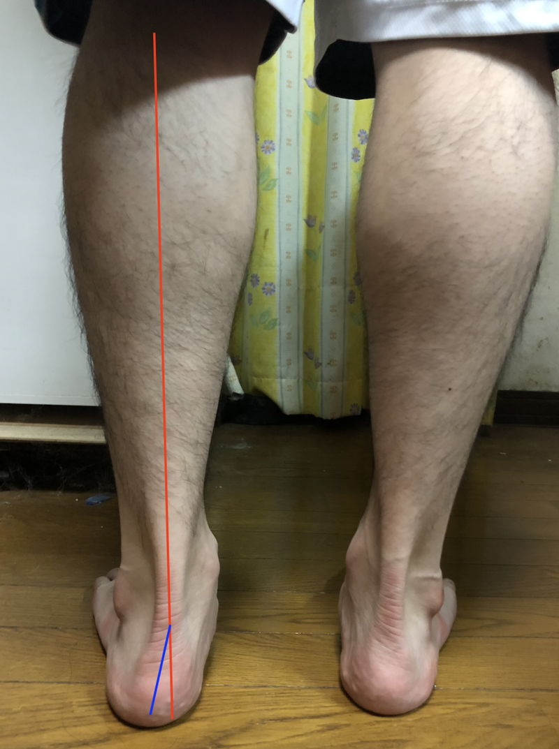 【FPI-6】足関節背屈制限の要因-距骨下関節- | 理学療法士・作業療法士・言語聴覚士の求人、セミナー情報なら【POST】